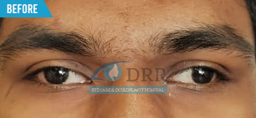 Squint Specialist In Chennai | Squint Eye Treatment In Chennai