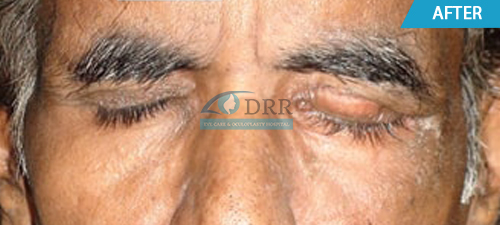 Facial paralysis treatment | facial paralysis surgery in chennai