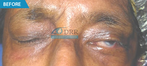 Facial paralysis treatment | facial paralysis surgery in chennai