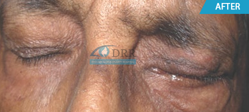 Facial paralysis treatment | facial paralysis surgery in chennai